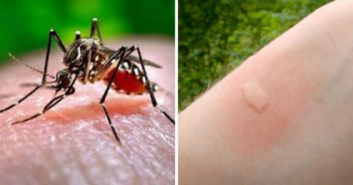 Here Are 8 Common Bug Bites And How You Can Recognize Them