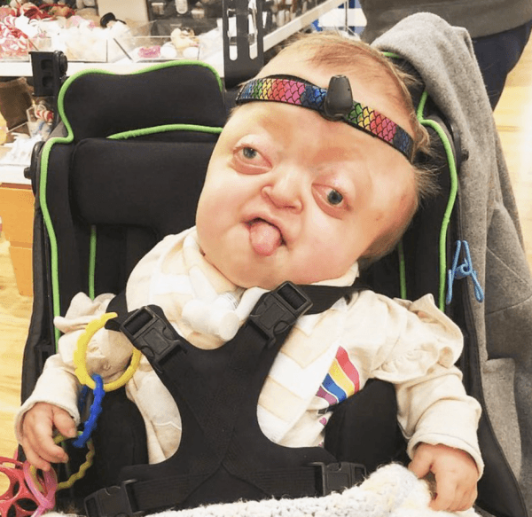 Mother Reveals What Life Is Like For Daughter With Rare Genetic ...