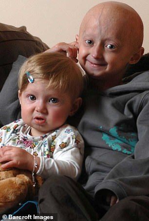 Brother And Sister Battle Rare 'Benjamin Button' Disease That Ages ...