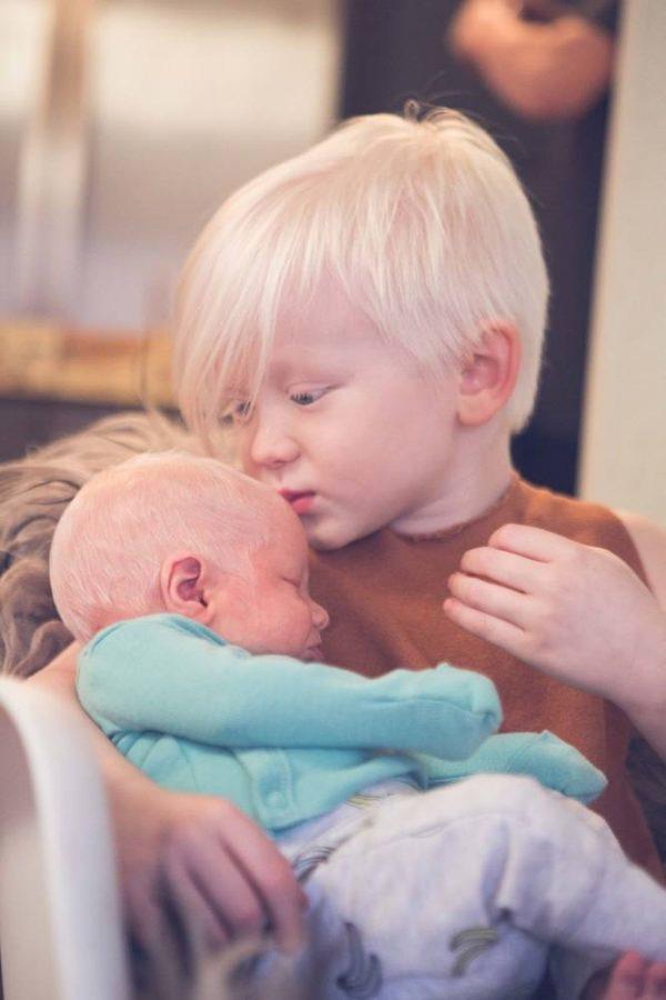 Mother Opens Up About How She's Raising Her Two Albino Sons