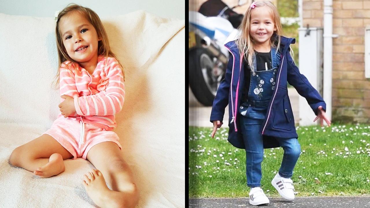 Toddler Born With Backward Legs Is Now Able To Walk After Life-Changing ...